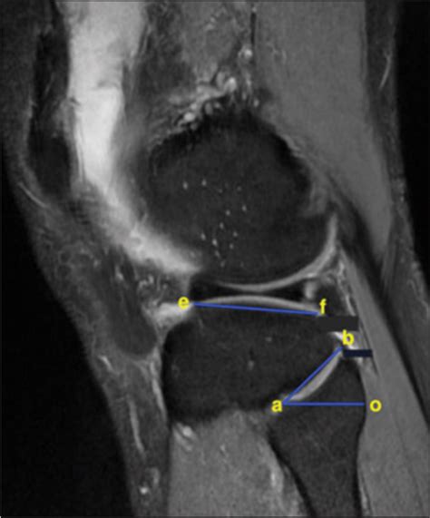 Morphometric Evaluation Of The Proximal Tibiofibular Joint Among