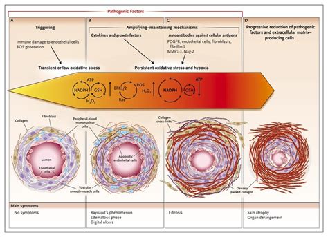Scleroderma Nejm