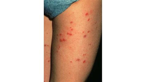 Complications Of Vasculitis Part 3 Bangladesh Post