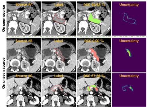 論文レビュー Generalizable Pancreas Segmentation Via A Dual Self Supervised
