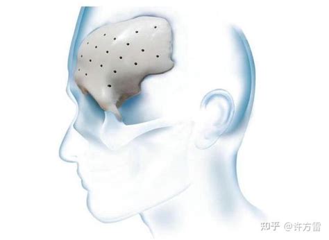 九院韦敏 Peek 3d在颅骨缺损方面的应用 知乎