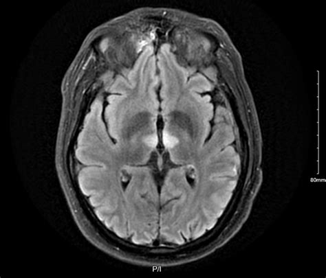 Bilateral Thalamic Infarct A Diagnosis Not To Sleep On Emra