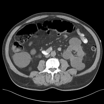 Hepatic Flexure Of Colon