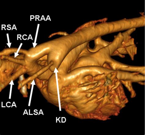 Kommerells Diverticulum In A Cat Volume Rendered 3 Dimensional Mdct Download Scientific