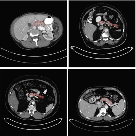 Iterative 3d Feature Enhancement Network For Pancreas Segmentation From Ct Images Request Pdf