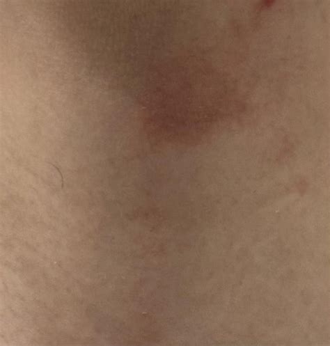 Dry Patch On Neck After Routine Help R Skincareaddicts