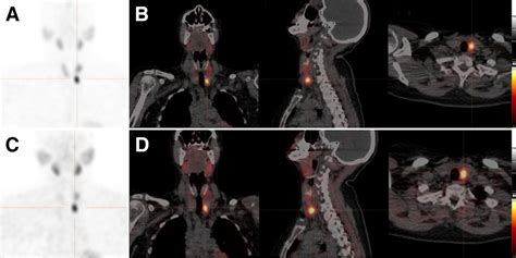 Simulated Fewer Angle Spectct Imaging Protocol For Parathyroid Adenoma