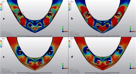 Pmax Values In The Cortical Bone In Model 1 A And Model 2 B And Download Scientific