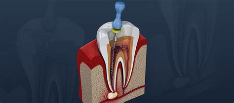 Root Canal Treatment