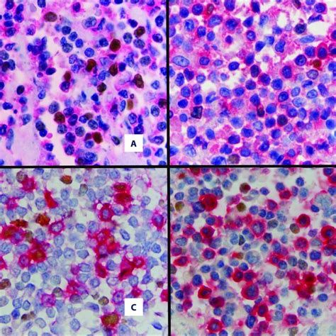 Histopathologic Nlphl Variants According To Fan Et Al A Pattern A B