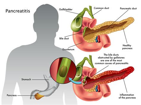Chronic Pancreatitis - Harvard Health