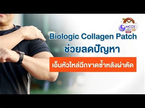 Biologic Collagen Patch ช่วยลดปัญหาเอ็นหัวไหล่ฉีกขาดซ้ำหลังผ่าตัด