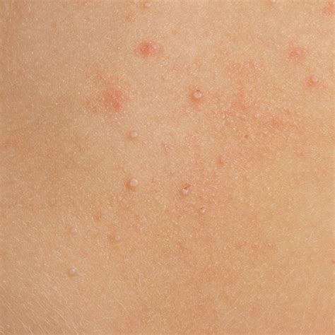 Molluscum Contagiosum Men Molluscum Contagiosum Chez Ladulte Byzok