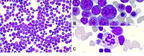 Figure 2 From Anti Cd71 Antibody Immunohistochemistry In The Diagnosis