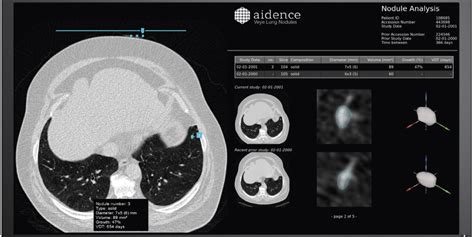 Improved Sensitivity In Lung Metastasis Detection On Preoperative Cts
