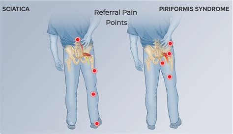 Understanding Piriformis Syndrome Vs Sciatica And The Role Of Remedial Massage