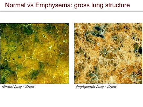 Ppt Obstructive Airway Diseases Powerpoint Presentation Free