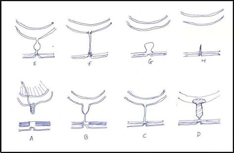 Omphalomesenteric Duct Remnants A Meckel Diverticulum With Separate