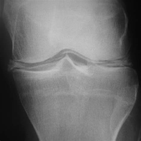 Plain Radiograph Showing Calcification Within The Hip Capsule Arrows Download Scientific