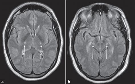 Amyotrophic Lateral Sclerosis And Its Mimics Variants A Comprehensive