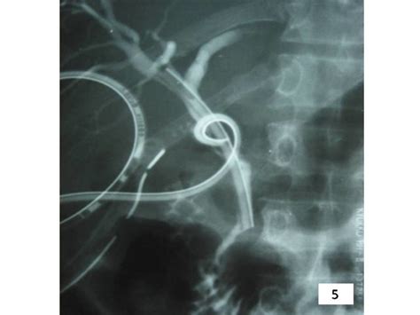 T Tube Cholangiogram 3 Weeks After Surgery Shows No Evidence Of