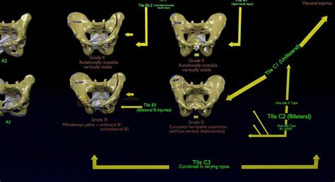 Pelvis Fracture Classifications 3d Model Superhive Formerly Blender Market
