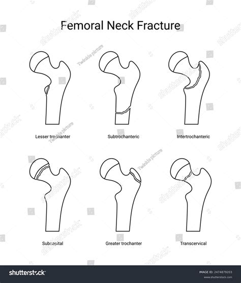 Types Femoral Neck Fracture Line Style Stock Vector Royalty Free
