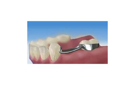 Space Maintainer Wide Wire W D Angel Dental Supply 🦷