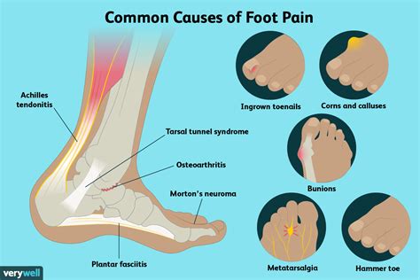 Foot Pain Arch Heel Area At Elvira Pierce Blog