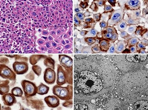 Crookes Hyaline Cytokeratin Em Showing Intermediate Filaments