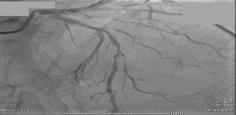 Laparoscopic Excision Of Normotensive Variant Pheochromocyto
