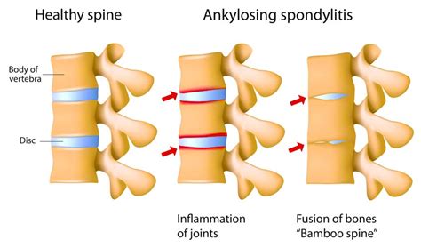 Acupuncture Ankylosing Spondylitis Relief Confirmed Healthcmi Ceus