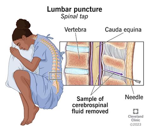 Lumbar Puncture Spinal Tap The Warrior Scroll