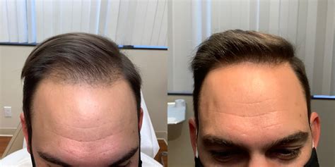 Microneedling Archives Torrey Pines Dermatology And Laser Center