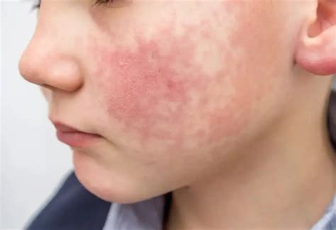 What Is Angioedema