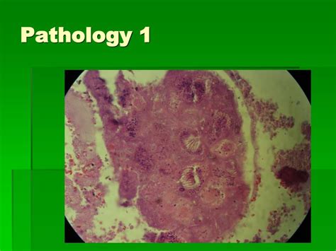 Ppt Pulmonary Echinococcus Powerpoint Presentation Free Download Id2689871