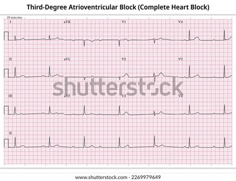Third Degree Atrioventricular Block Ecg Paper Stock Vector Royalty