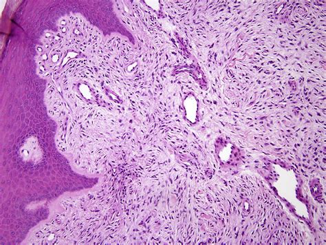 Myxoid Neoplasms Surgical Pathology Clinics