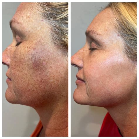 Ipl Photofacials Skin Essentials