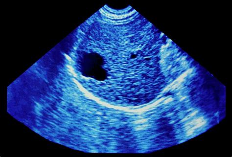 Liver Cyst Photograph By Gca Pixels