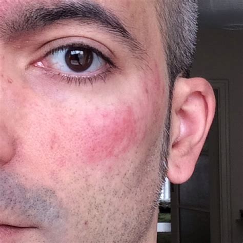 Feeling Like Samantha After Her Botox Session Got A Rash Flickr