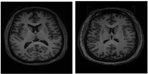 Detection Of Bipolar Disorder And Schizophrenia Employing Bayesian