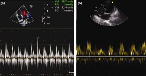 Constrictive Pericarditis Causes Symptoms Diagnosis Management And Prognosis