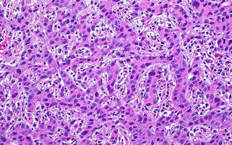 Poorly Differentiated Colon Adenocarcinoma Light Micrograph Stock
