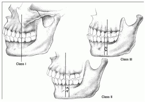 Mandible Fracture Classification