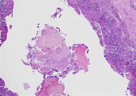 Pathology Outlines Aspergillus