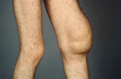 Joint Effusion To Test For Minimal Joint Effusion Note That Even A