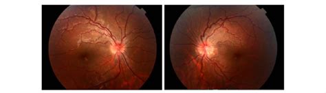 Fundus Evaluation Showed An Aspect Of Bilateral Papilledema Grade Ii