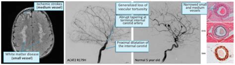 Signs And Symptoms ∙ Acta2 Alliance ∙ Foundation For Multisystemic Smooth