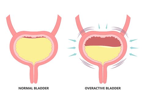 Overactive Bladder Symptoms